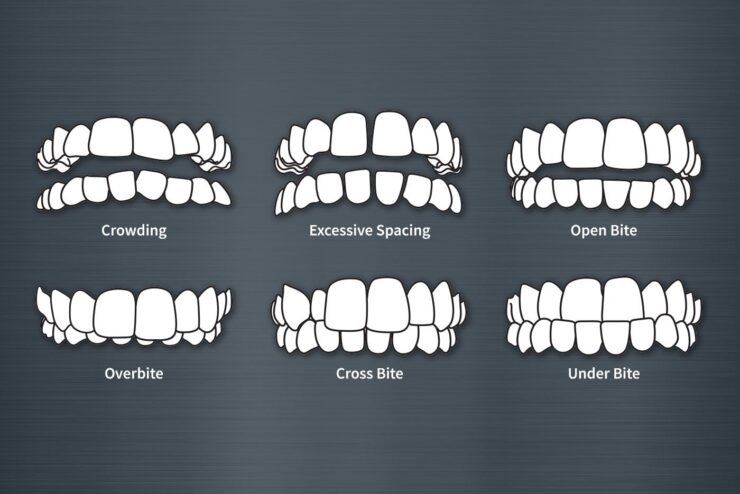The Benefits Of Orthodontic Treatment: Straightening Your Teeth And ...