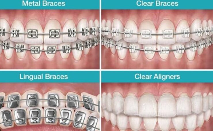 Considering Getting Braces? Here’s What You Need to Know - Aquila Style
